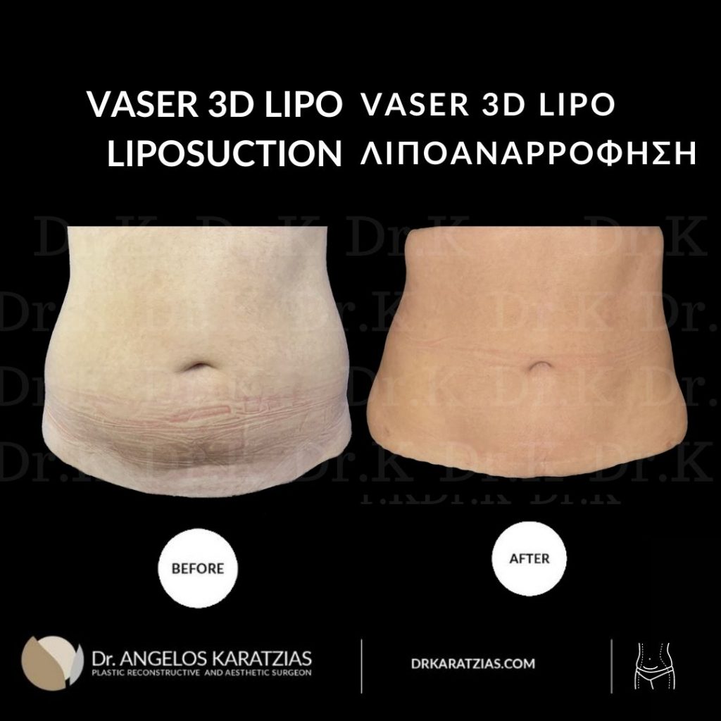 Vaser 3D Lipo | Minimally Invasive Liposuction - Plastic Surgeon Cyprus