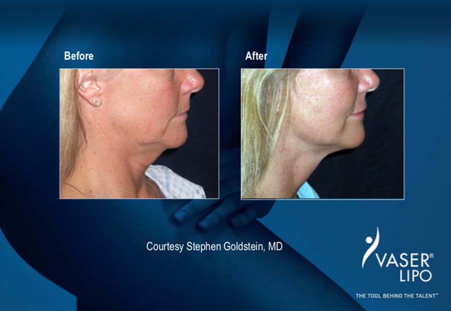 Vaser 3D Λιποαναρρόφηση | Εξελιγμένη τεχνολογία με υπερήχους